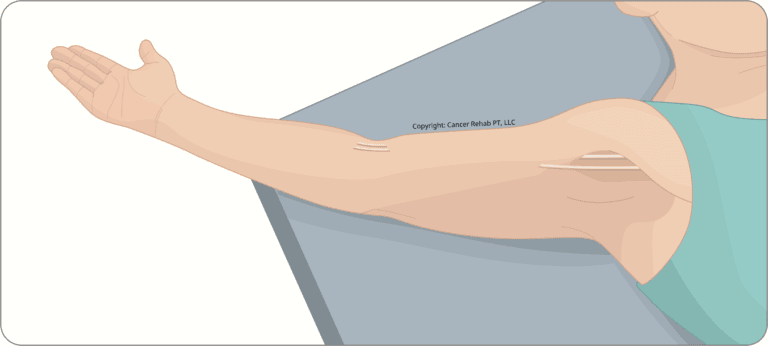 Your Guide to Getting Rid of Axillary Web Syndrome (Cording) - Cancer ...