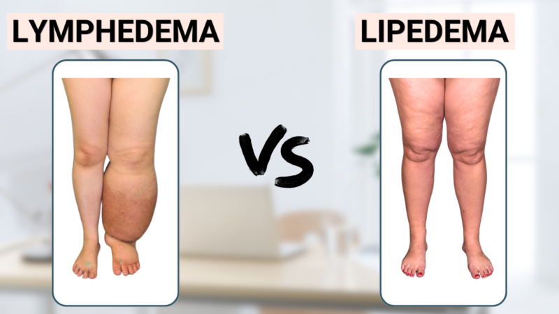 Lipedema vs Lymphedema: What's the Difference & What to Do - Cancer ...