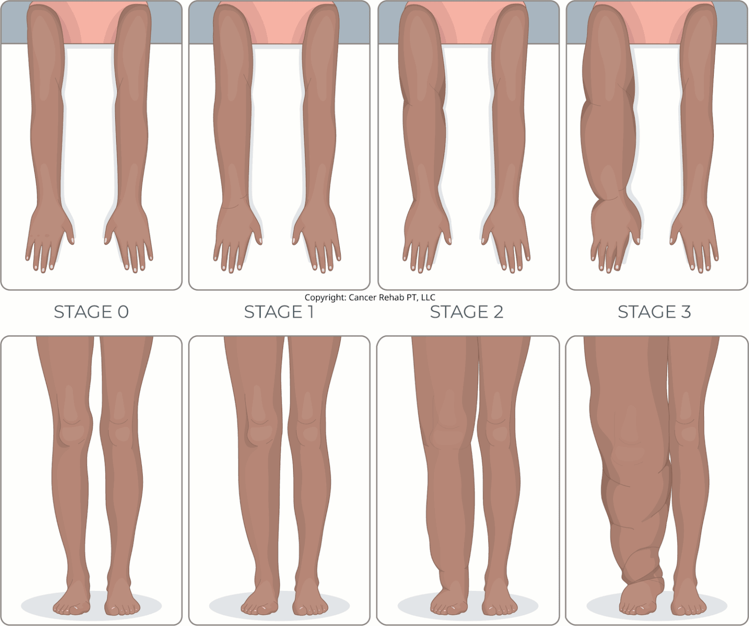 Lymphedema Stages: How to Manage Swelling From 0 to 3