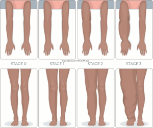 Lymphedema Stages: How to Manage Swelling From 0 to 3