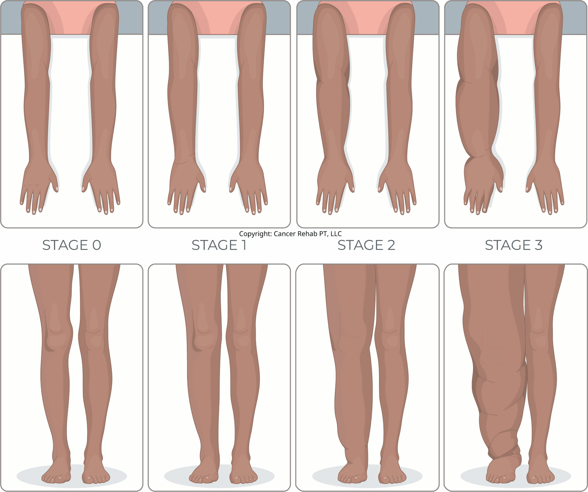 Lymphedema Stages: How to Manage Swelling From 0 to 3