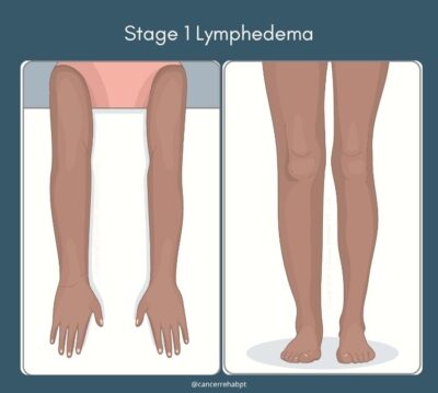 Lymphedema Stages How To Manage Swelling From 0 To 3