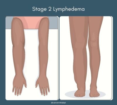Lymphedema Stages: How to Manage Swelling From 0 to 3