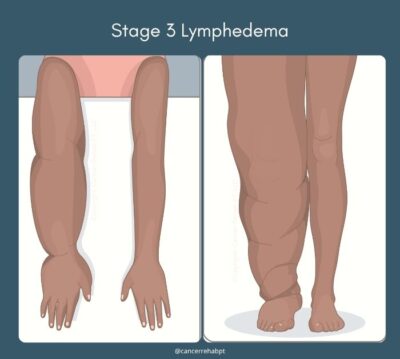 Lymphedema Stages: How to Manage Swelling From 0 to 3