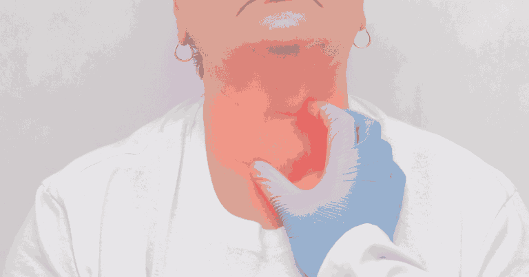 Lymphedema Neck and Head Swelling: How to Reduce It