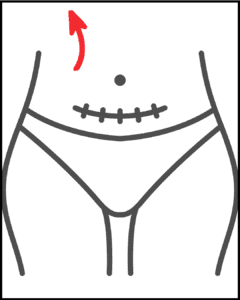 Swelling After C-Section: How to Safely Reduce It